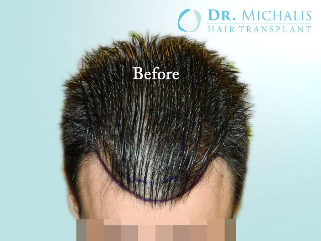 Hair Transplant without shaving head | Unshaved Hair Transplant Hair ...